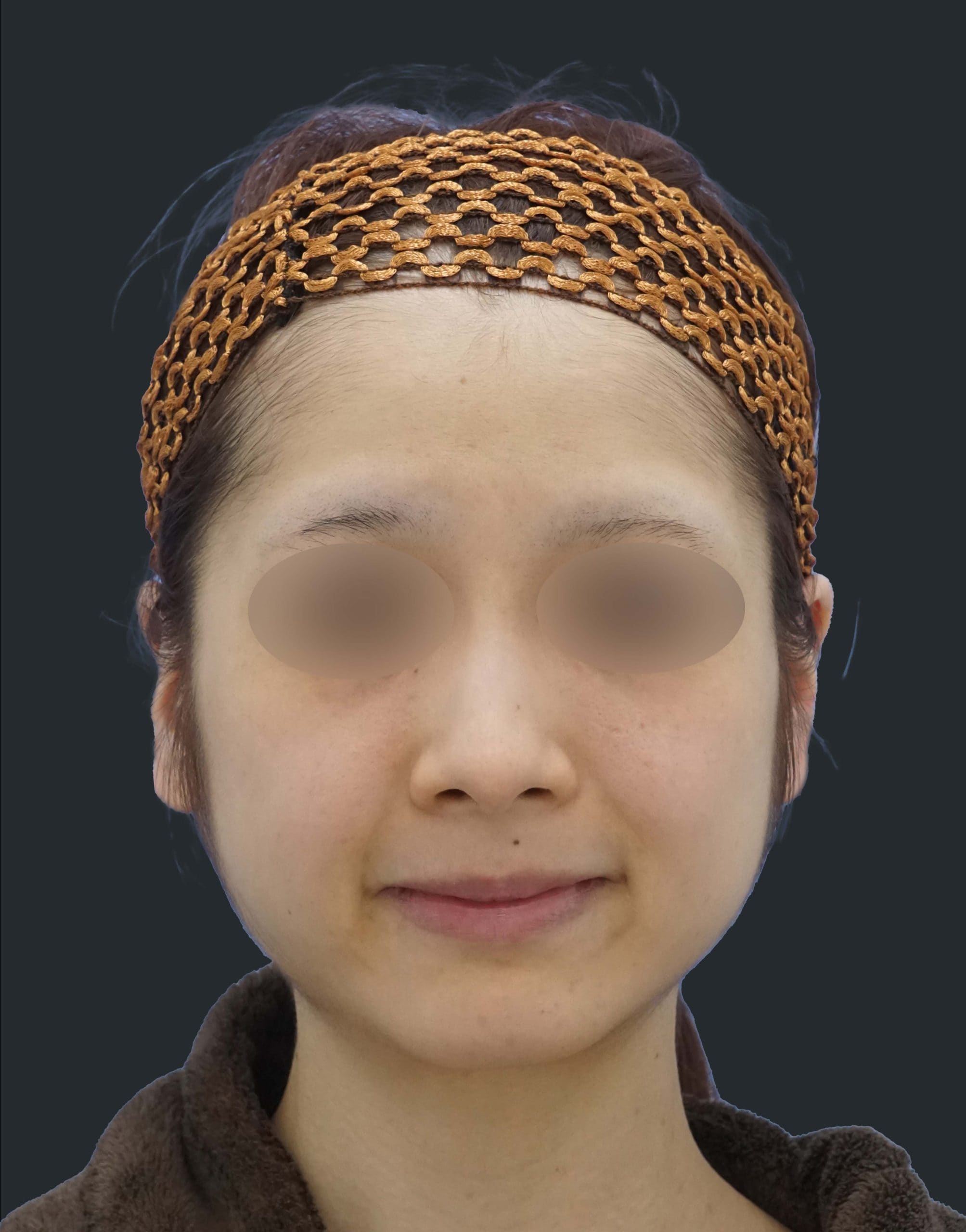 Improve a Long Face Without Bone Cutting! “3 Causes” and “Improvement ...