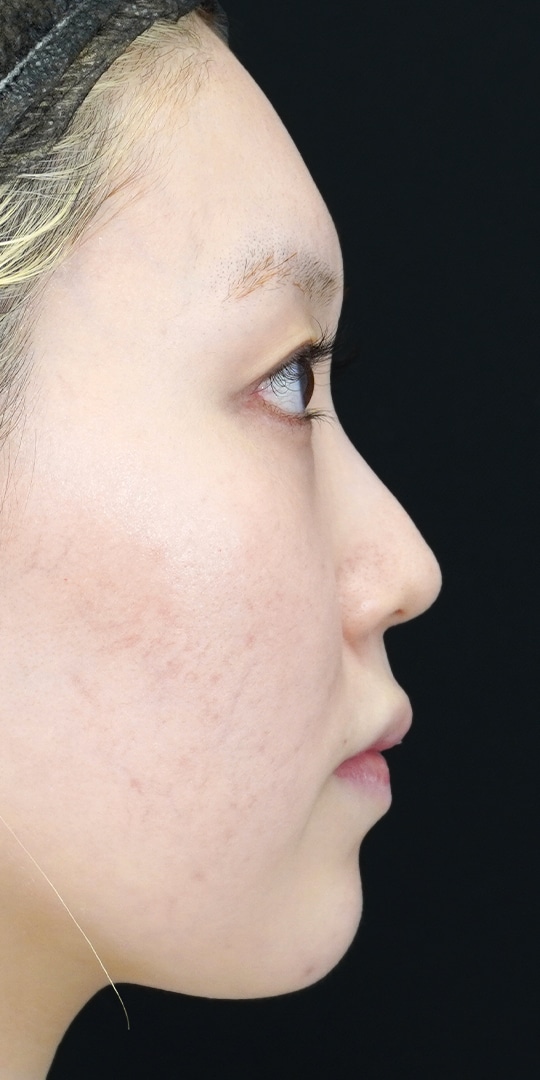 【中顔面陥没】を治したい…貴族手術不要！鼻整形をすると治る！？湘南美容クリニック原宿院(東京・渋谷) - 原宿院
