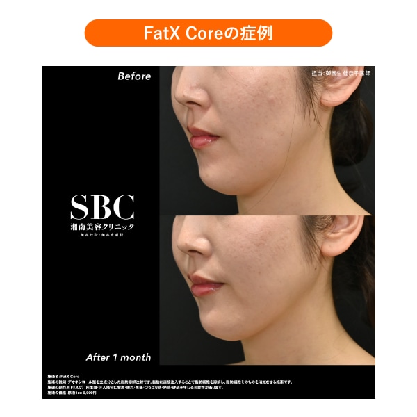 【SNSでも話題！】従来の1万倍配合の脂肪溶解注射「FatX Core」が松戸院で取扱開始 - 松戸院